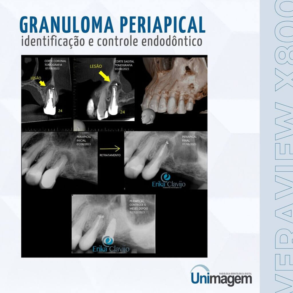Granuloma Periapical - UNIMAGEM
