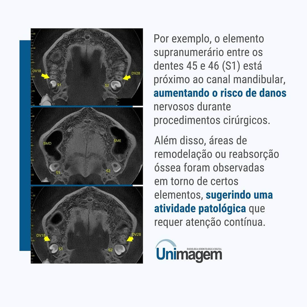 Diagnóstico de Dentes Supranumerários - UNIMAGEM