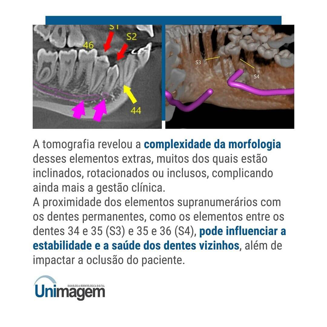 Diagnóstico de Dentes Supranumerários - UNIMAGEM