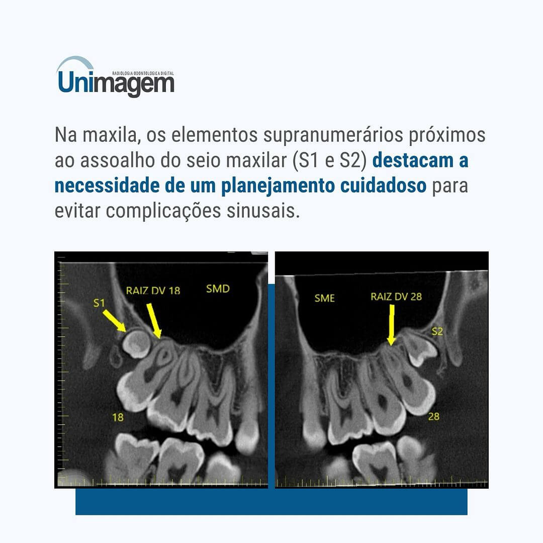 Diagnóstico de Dentes Supranumerários - UNIMAGEM