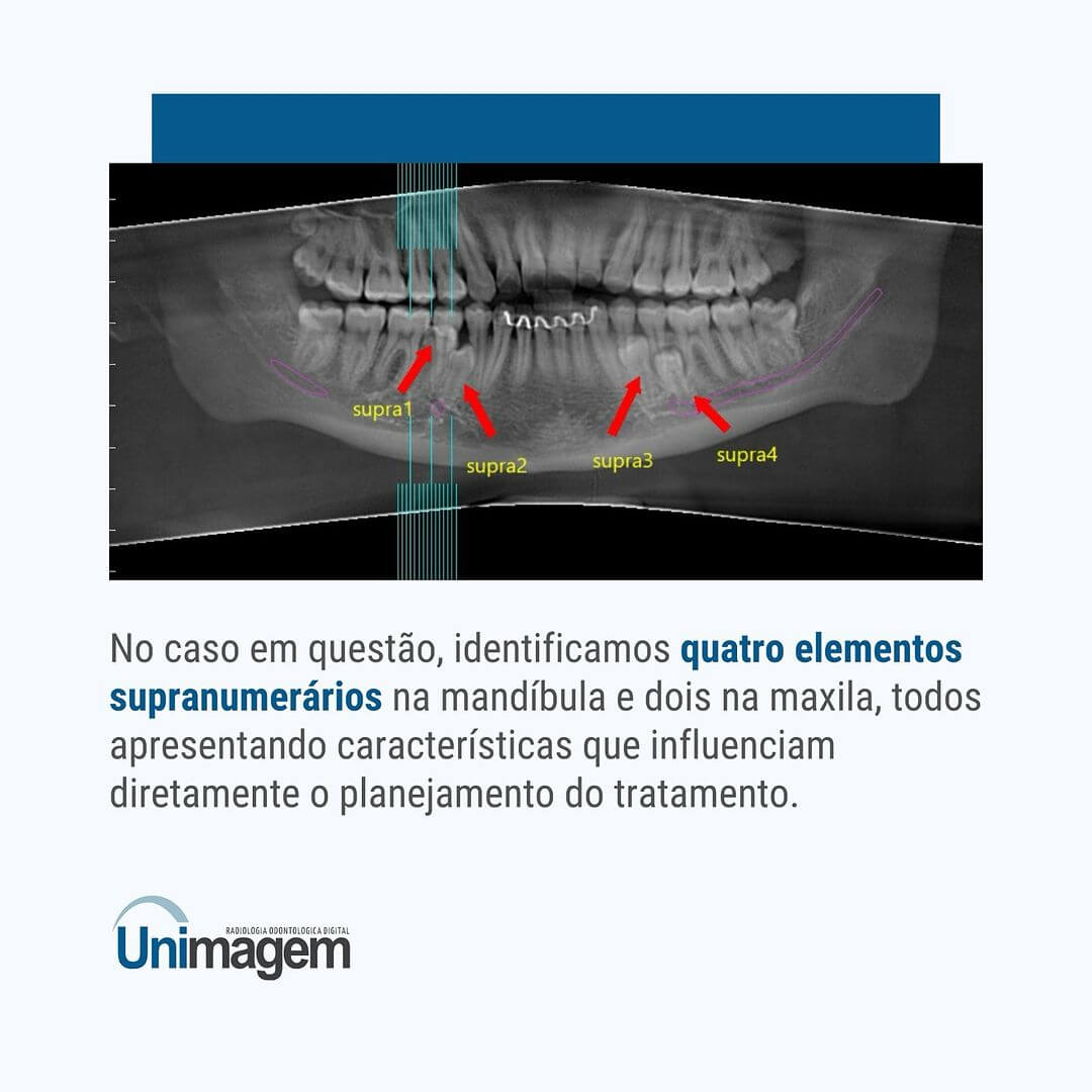 Diagnóstico de Dentes Supranumerários - UNIMAGEM